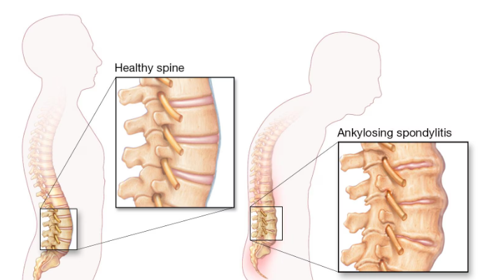Ankylosing spondylitis – SpineAlign